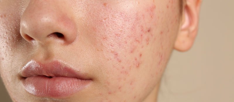 Cara Menghilangkan Bekas Jerawat dengan 4 Bahan Alami • CISAS