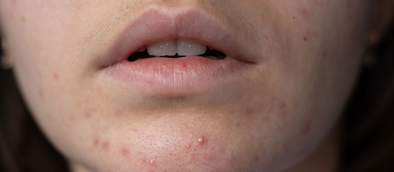 Penyebab Jerawat Pustula dan Cara Mengobatinya • CISAS